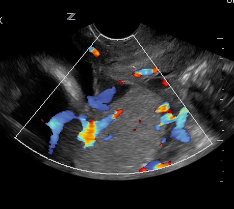 Marginal Placenta Previa • Sonosession