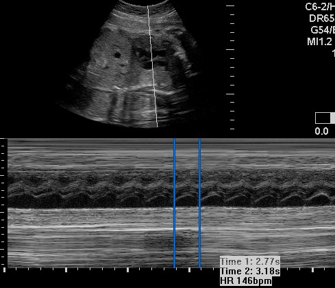 Marginal Placenta Previa • Sonosession