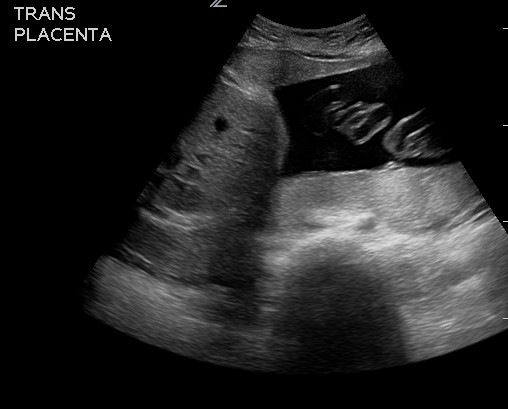 Marginal Placenta Previa • Sonosession