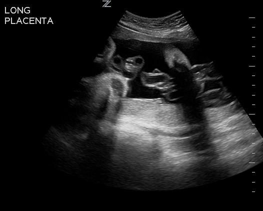 Marginal Placenta Previa • Sonosession