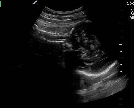 Marginal Placenta Previa • Sonosession