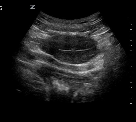 Confirming IUD Placement • Sonosession
