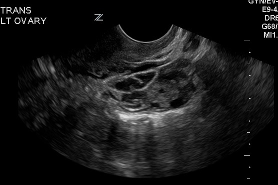 Confirming IUD Placement • Sonosession