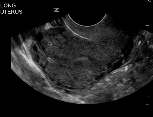 Confirming IUD Placement • Sonosession