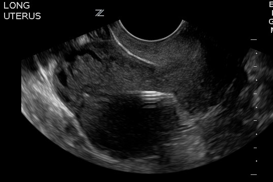 Confirming IUD Placement • Sonosession
