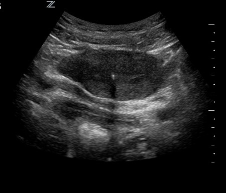 Confirming IUD Placement • Sonosession
